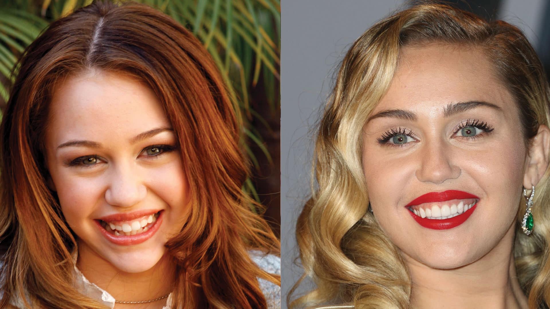 Top Celebrities Who Have Hollywood Smile | SurgeryTR