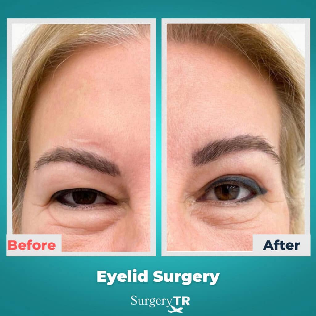 Eyelid Surgery in Turkey - Blepharoplasty | SurgeryTR