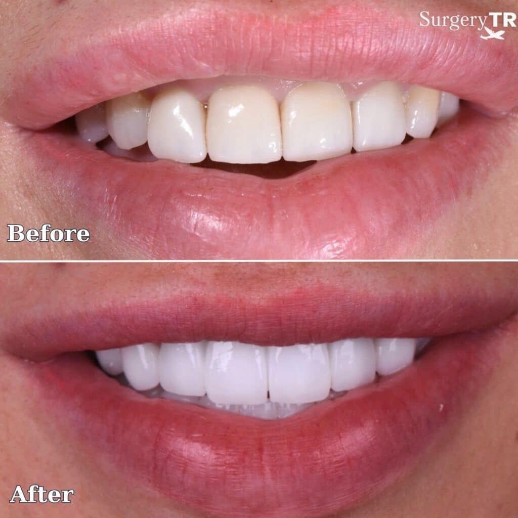 Dental Implants in Turkey (Tooth Implant) | SurgeryTR