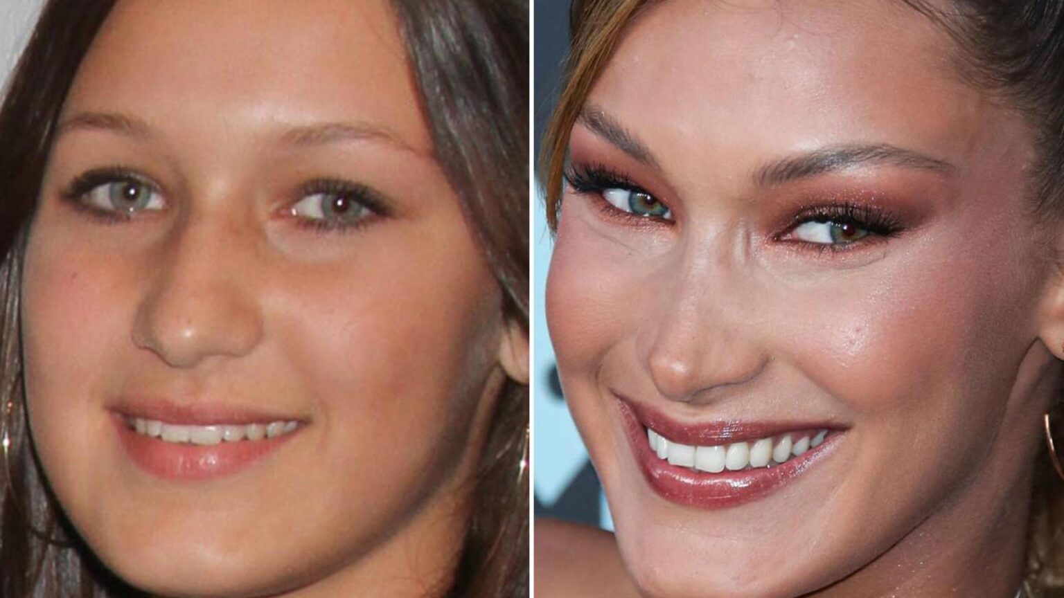Bella Hadid’s Plastic Surgeries | SurgeryTR
