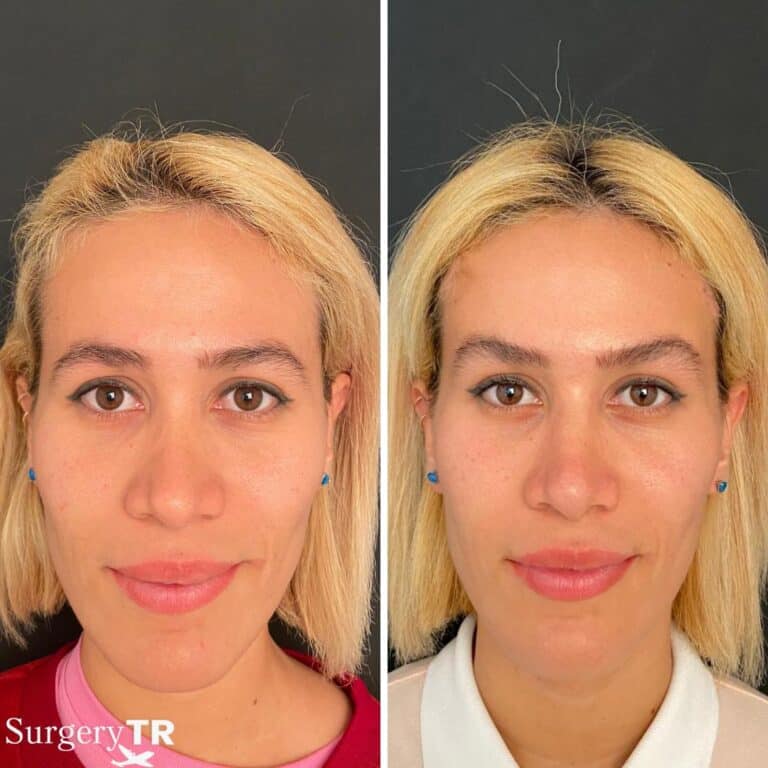 Brow Lift In Turkey Plastic Surgery Turkey