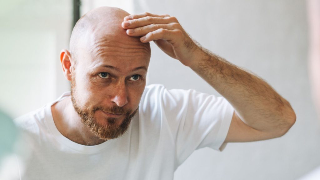 Male Pattern Baldness: What Causes It? - Surgerytr