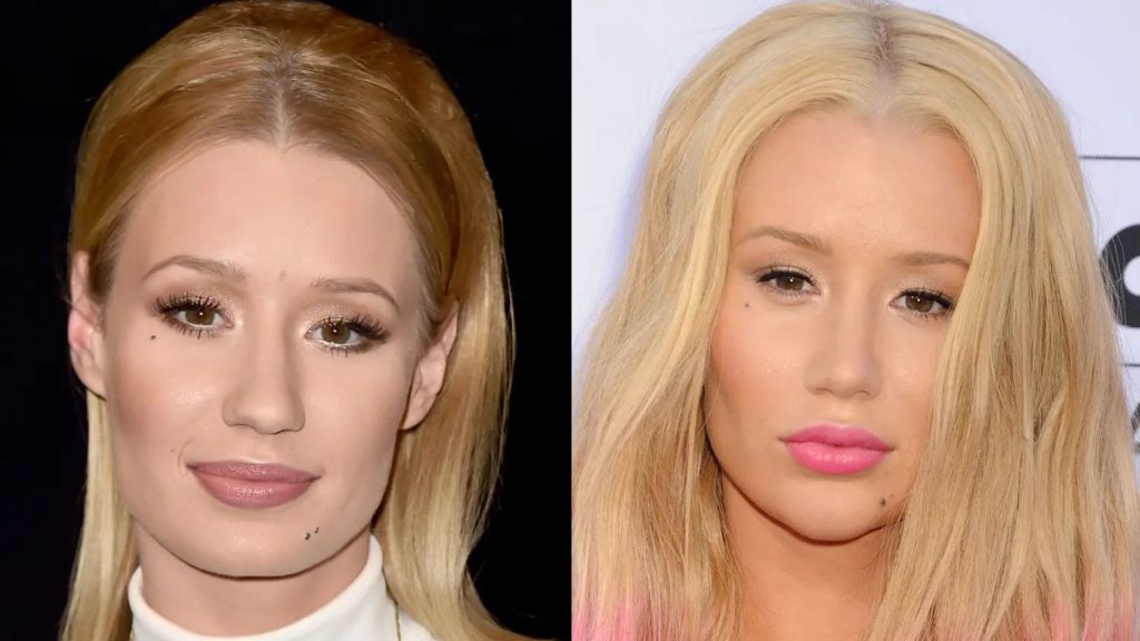 Iggy Azalea Plastic Surgery - Surgerytr