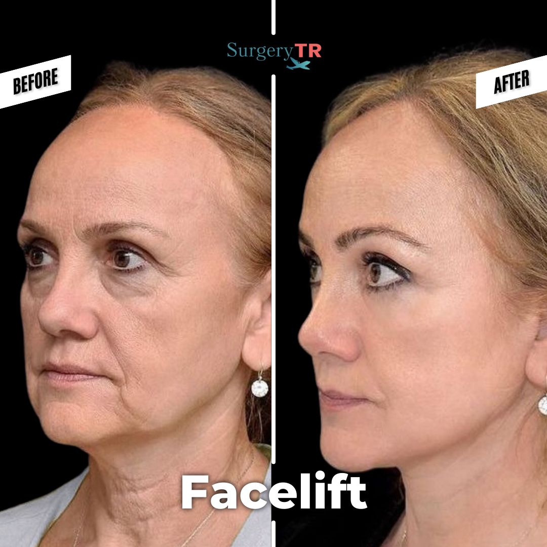 Did Kate Middleton Get Plastic Surgery? Is It Allowed in the Royal ...